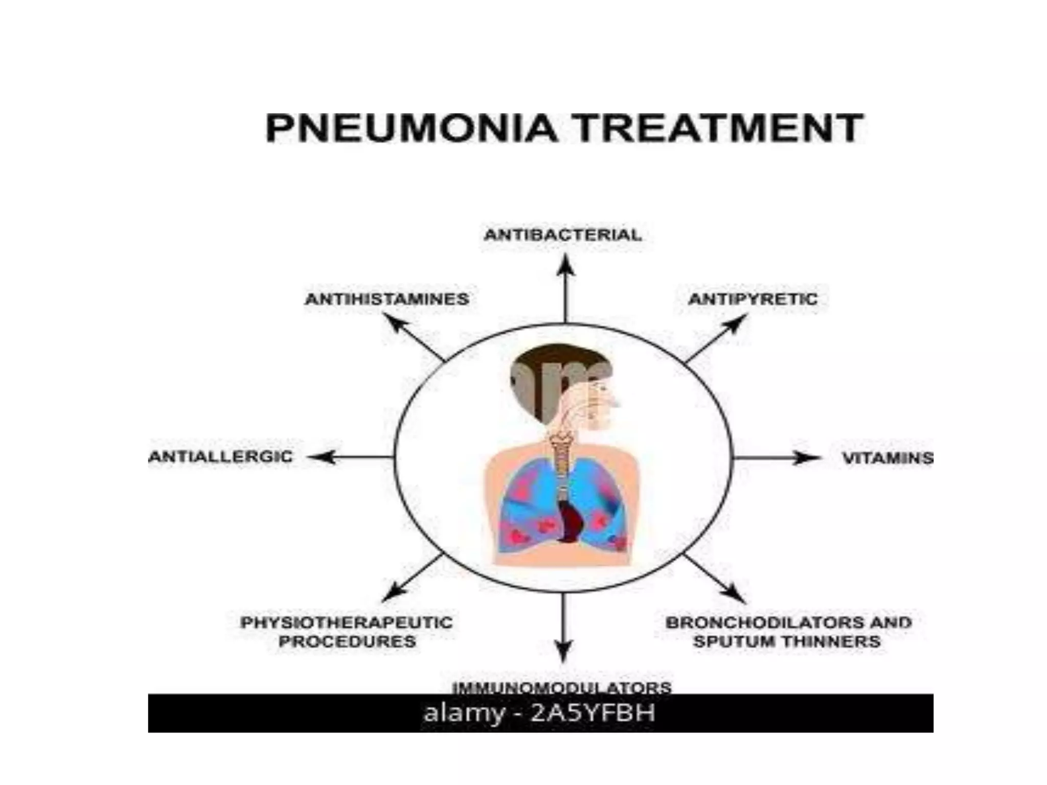 pneumonia.pptx