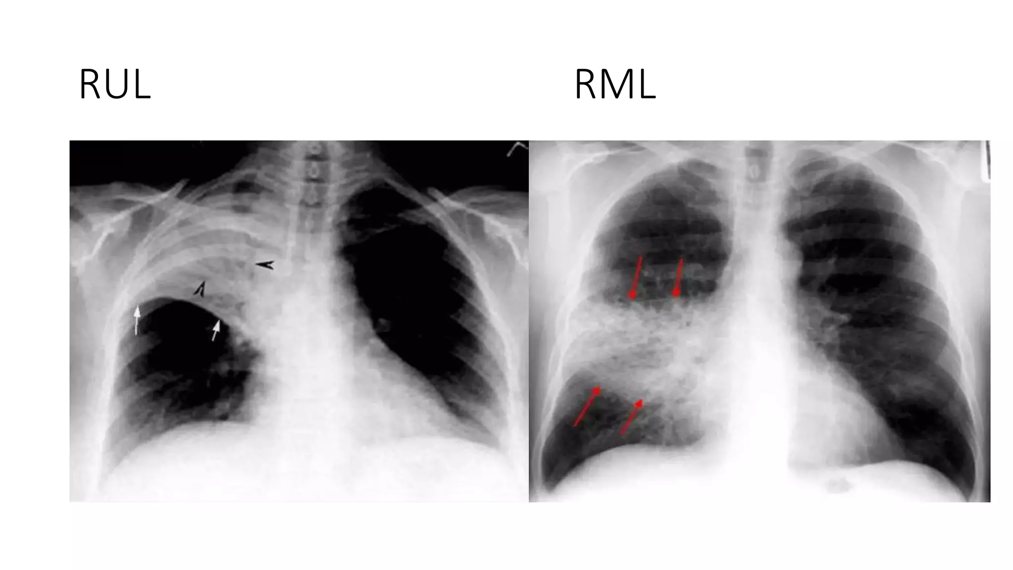 pneumonia.pptx