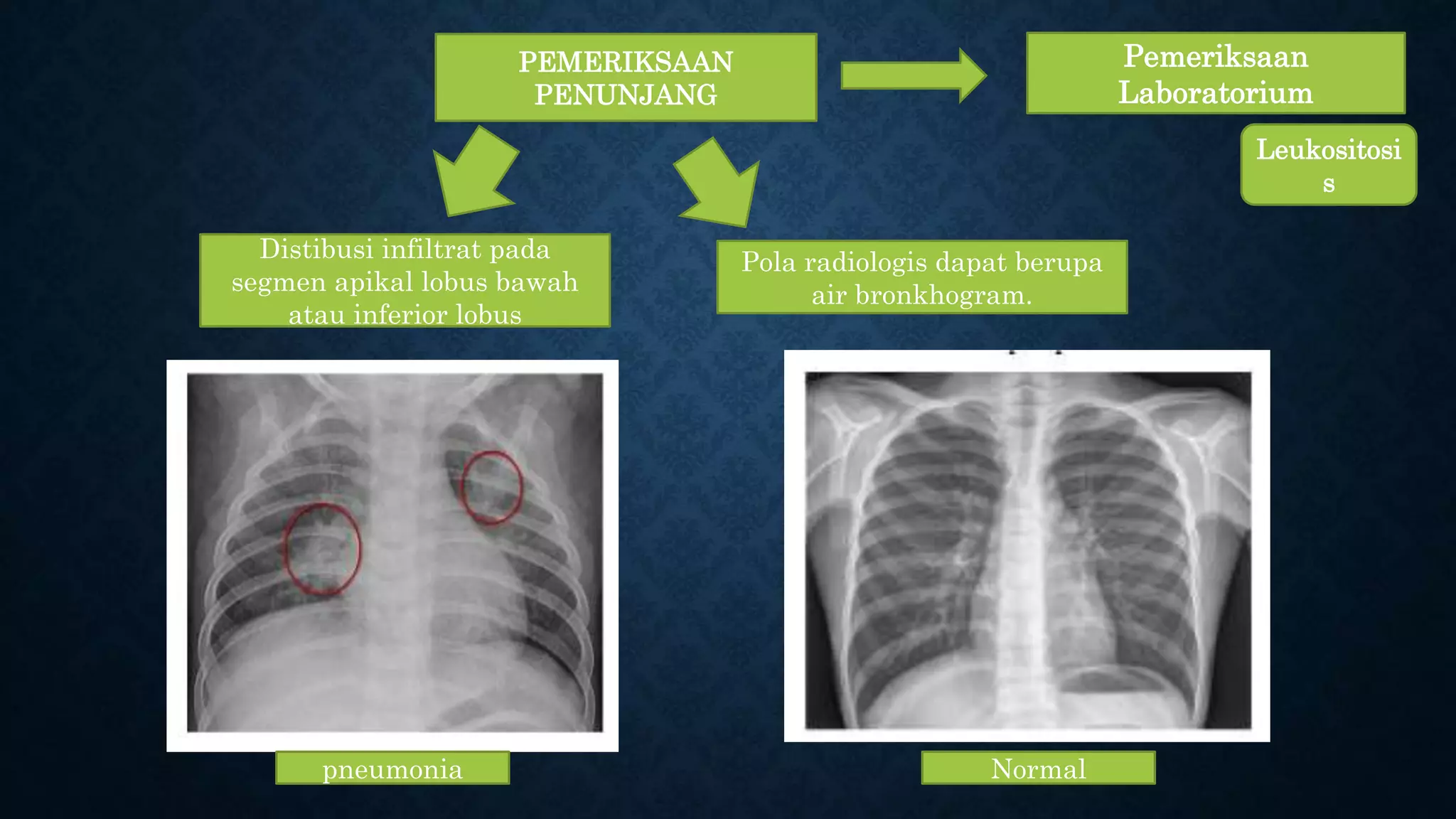 pneumonia.pptx