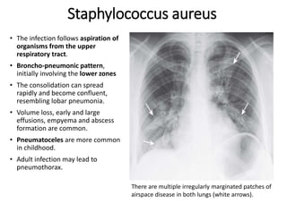 Pneumonia.pptxojasojioiosiokiiijijidjijioaj | PPT