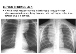 Pneumonia.pptxojasojioiosiokiiijijidjijioaj | PPTX