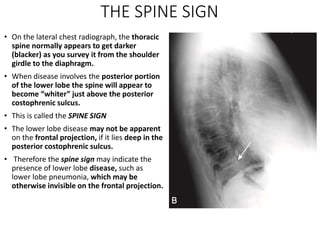 Pneumonia.pptxojasojioiosiokiiijijidjijioaj | PPT