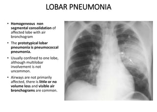 Pneumonia.pptxojasojioiosiokiiijijidjijioaj | PPT