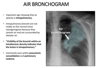 Pneumonia.pptxojasojioiosiokiiijijidjijioaj | PPT