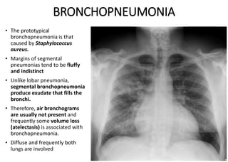 Pneumonia.pptxojasojioiosiokiiijijidjijioaj | PPT