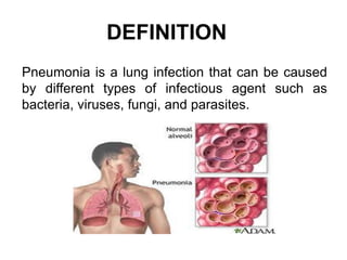 Pneumonia and its causes sign symptome treatment | PDF