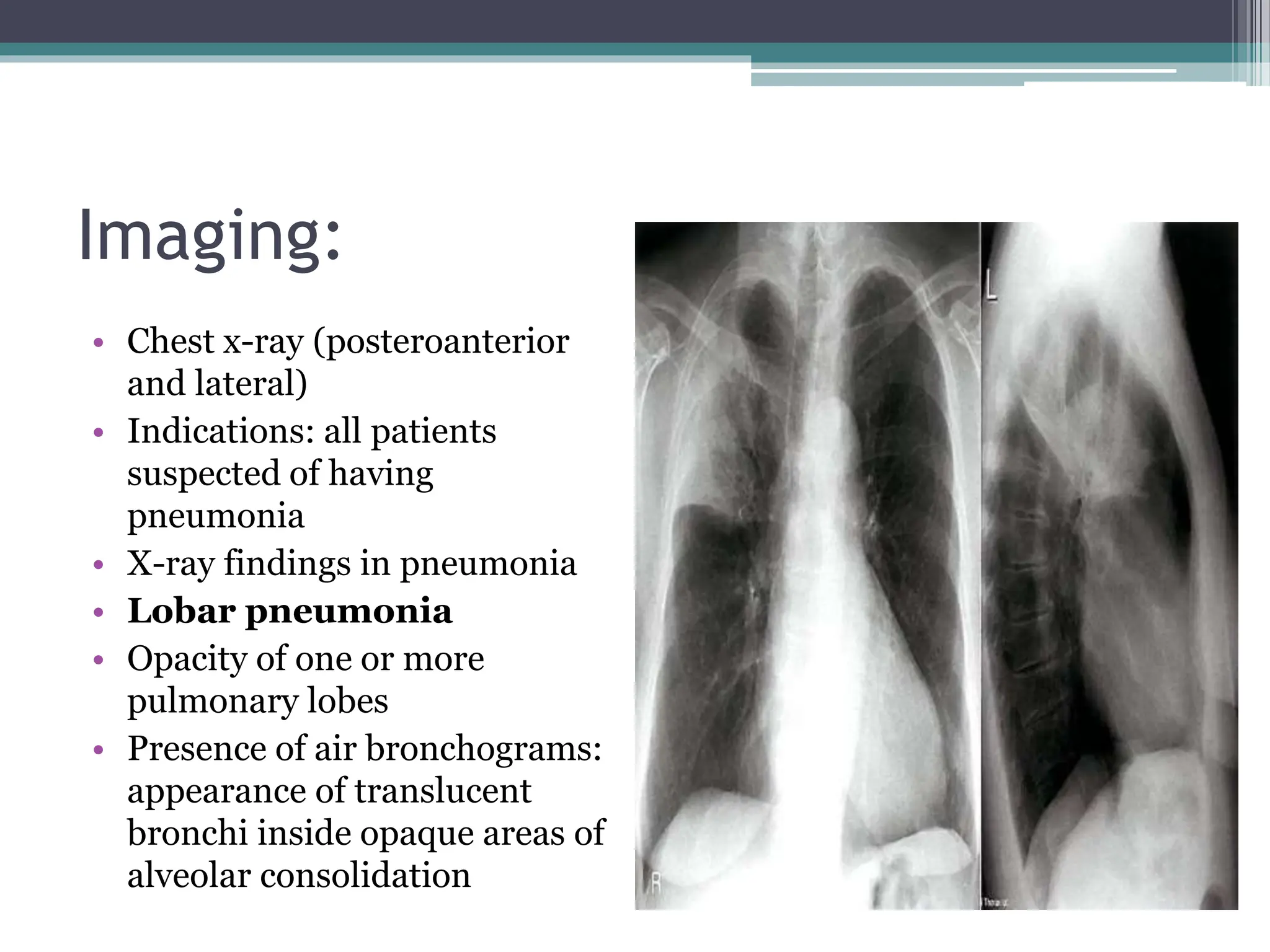 types of Pneumonia ,complications and treatment .pptx