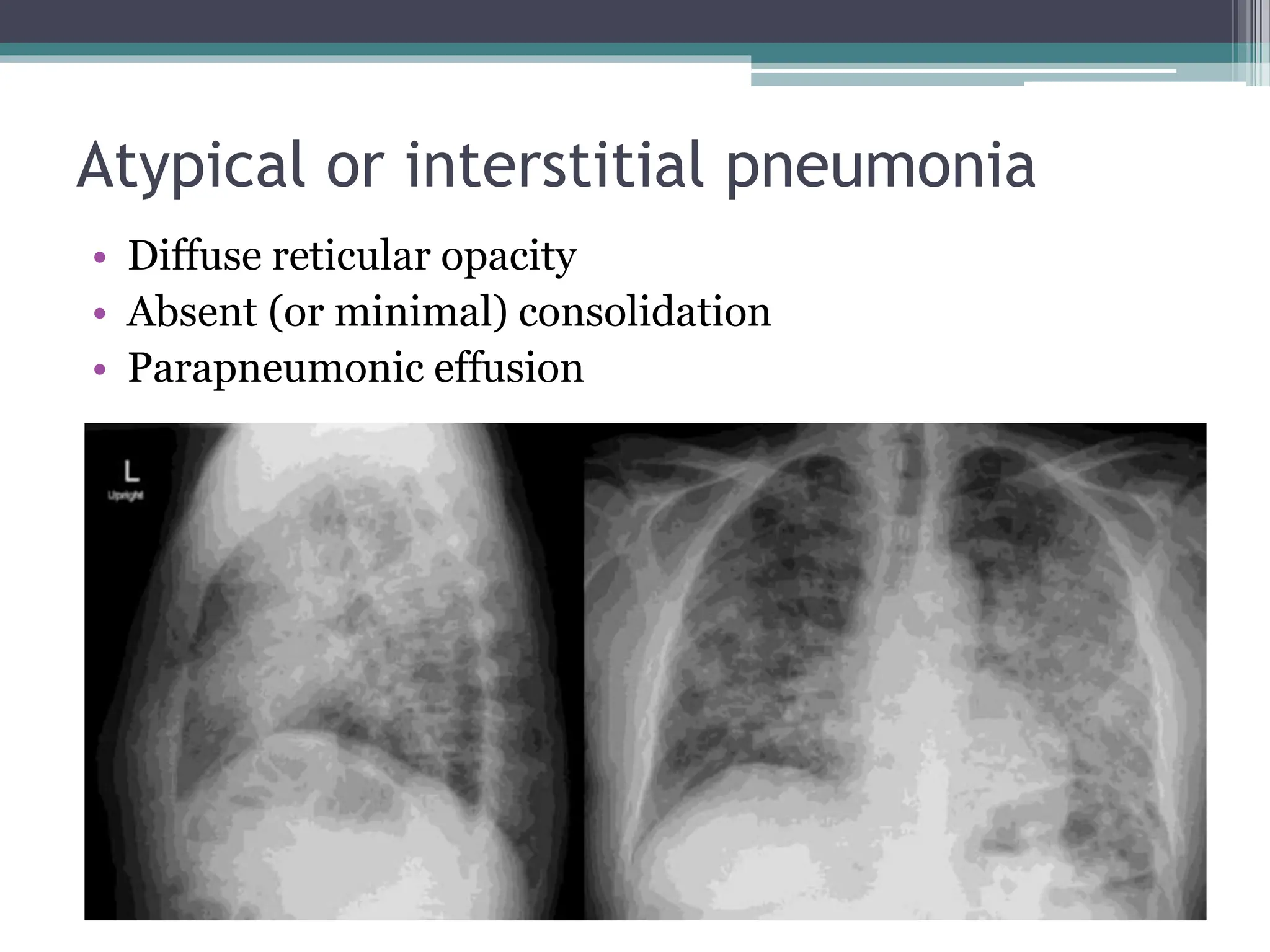 types of Pneumonia ,complications and treatment .pptx