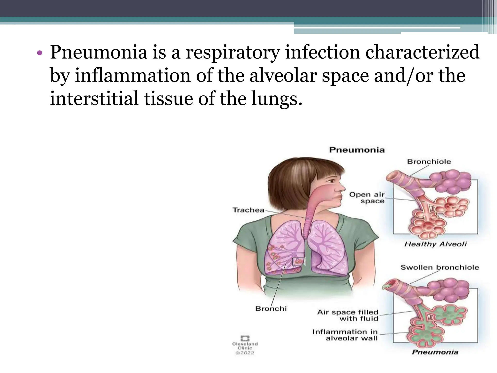 types of Pneumonia ,complications and treatment .pptx
