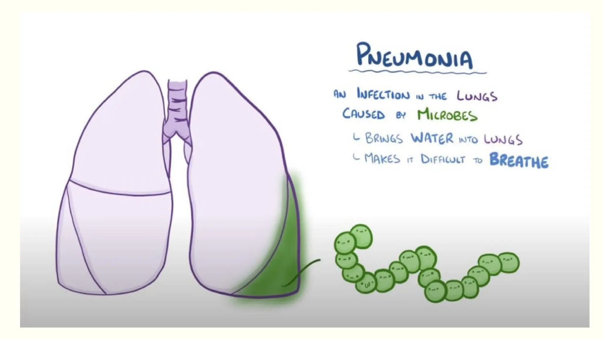 PNEUMONIA AND ITS MANAGEMENT WITH TREATMENT.pptx