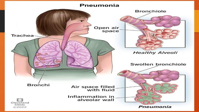 pneumonia.pptx Pneumonia is defined as inflammation with exudative ...
