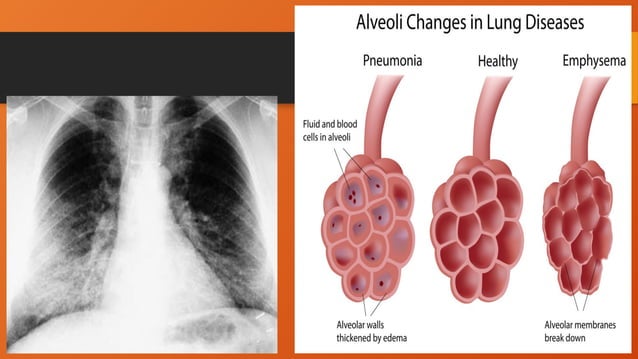 pneumonia.pptx Pneumonia is defined as inflammation with exudative ...