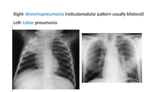 Pneumonia a lung infection causing cough, fever, and dyspnea. | PPTX