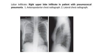 Pneumonia a lung infection causing cough, fever, and dyspnea. | PPT