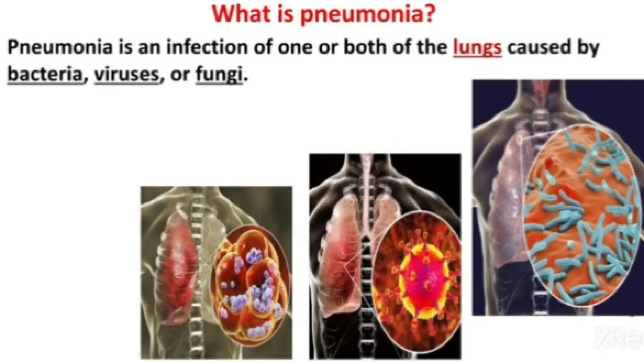 Pneumonia presentation children .pptx