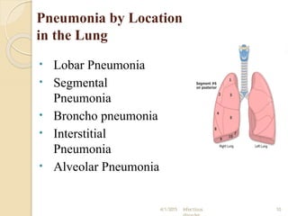 Pneumonia Respiratory system disorders presentation | PPTX