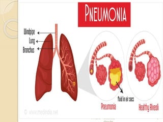 Pneumonia Respiratory system disorders presentation | PPTX
