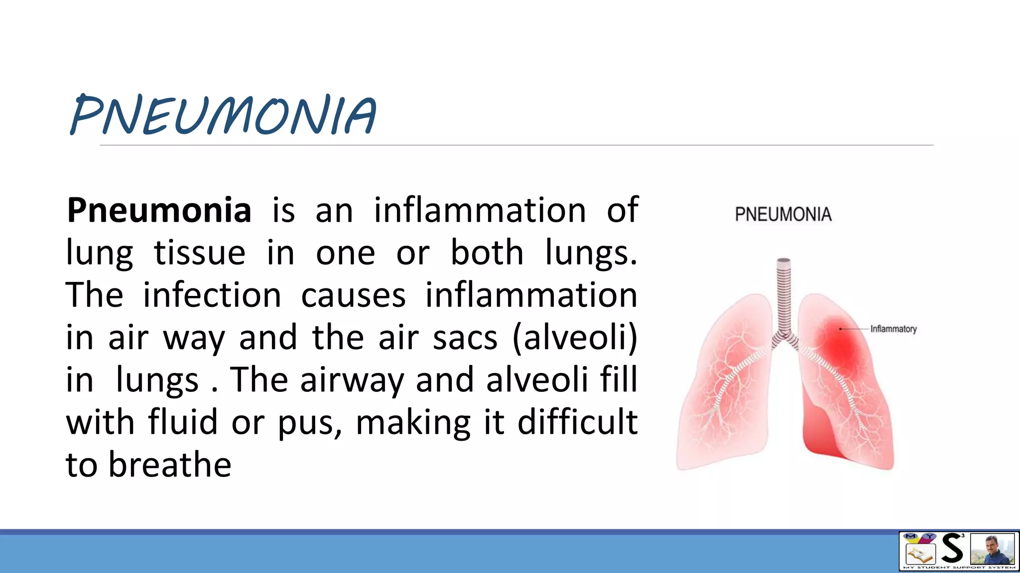 Pneumonia in english | PPTX