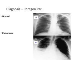 gangguan sistem pernafasan - pneumonia - | PPT
