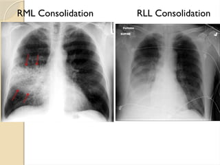PNEUMONIA ppt 8199473-19291910 pneumonia final | PPTX