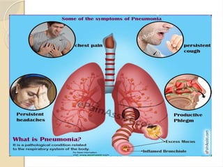 PNEUMONIA ppt 8199473-19291910 pneumonia final | PPTX