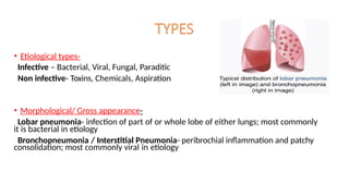 PNEUMONIA-types and classification .pptx