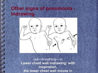 Pneumonia in peadiatrics | PPT