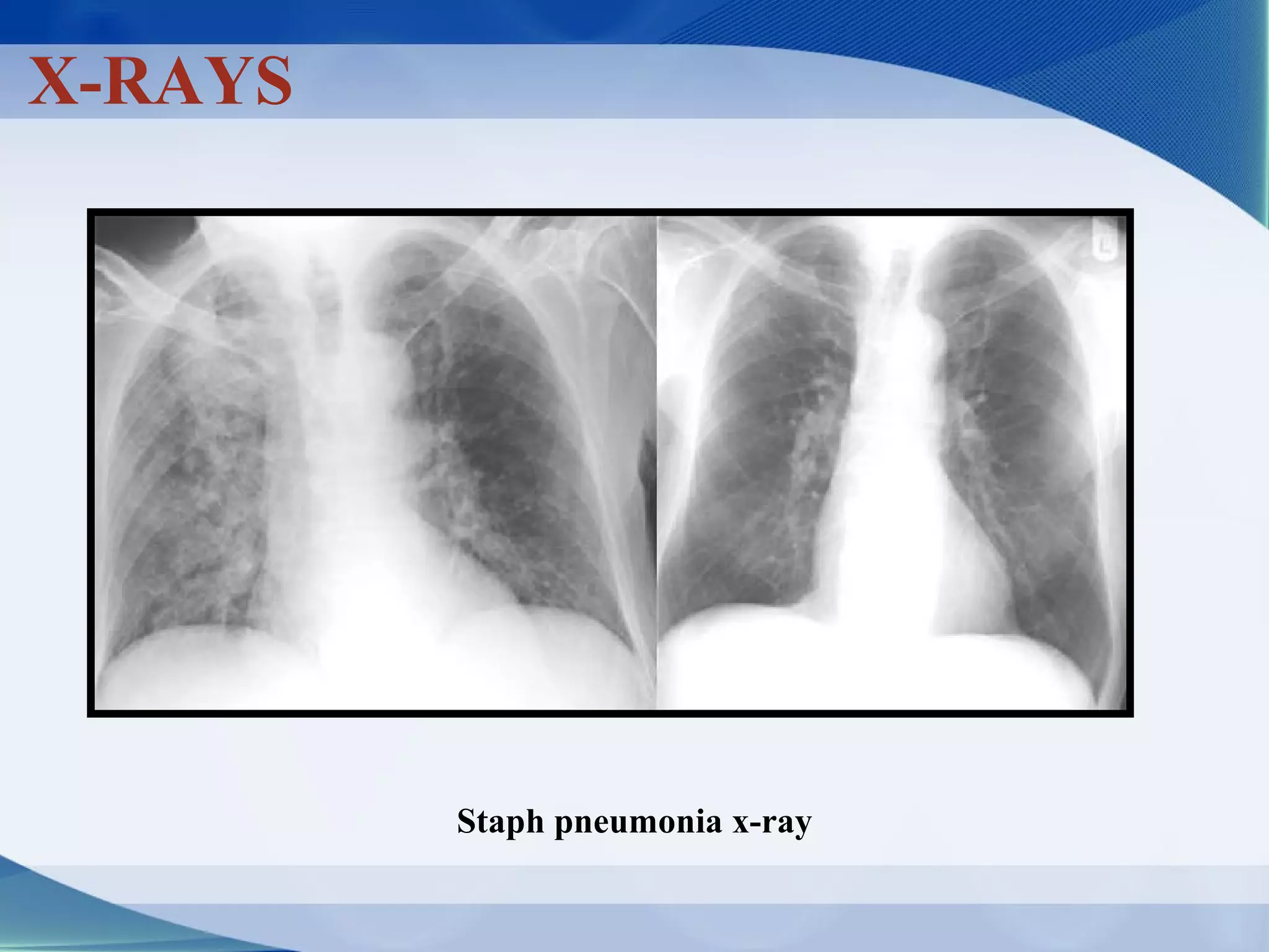 classification of pnemonia | PPT