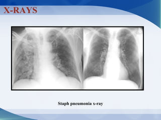 classification of pnemonia | PPT