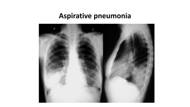 PNEUMONIA lung disease in patient in ICU | PDF