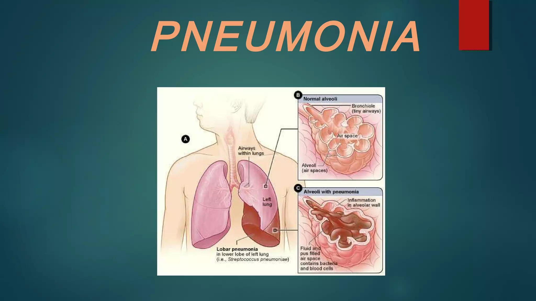Pneumonia | PPT