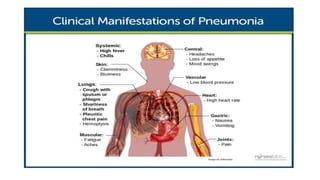 PNEUMONIA-CLASSIFICATION, MANAGEMENT AND COMPLICATIONS | PPT