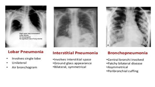 PNEUMONIA-CLASSIFICATION, MANAGEMENT AND COMPLICATIONS | PPT