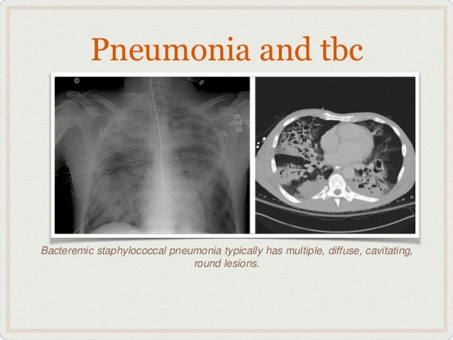 Pneumonia and tuberculosis