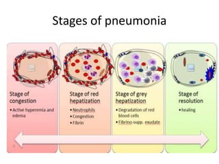 PNEUMONIA .pptx