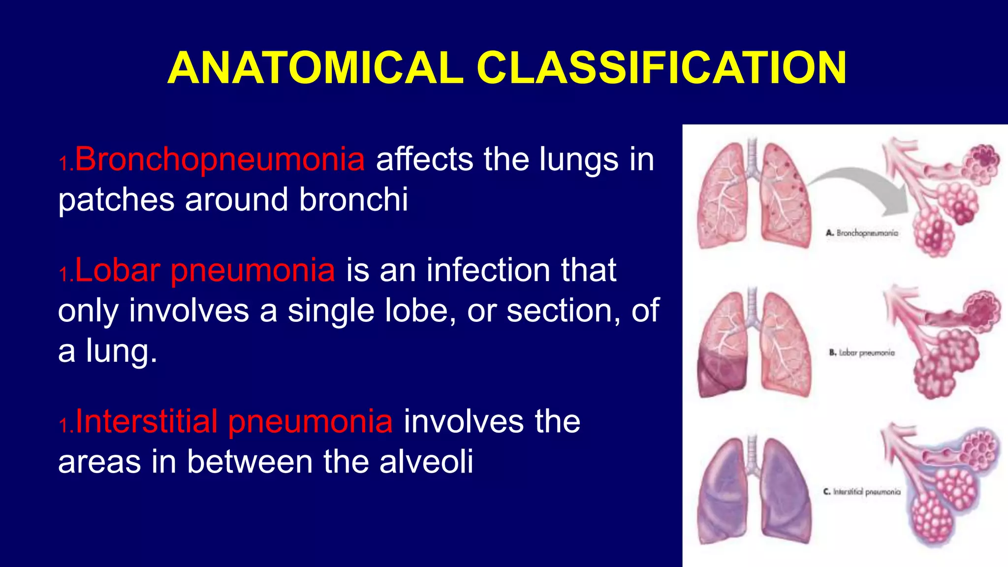 Pneumonia | PPTX