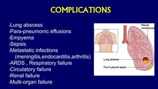 Pneumonia | PPTX