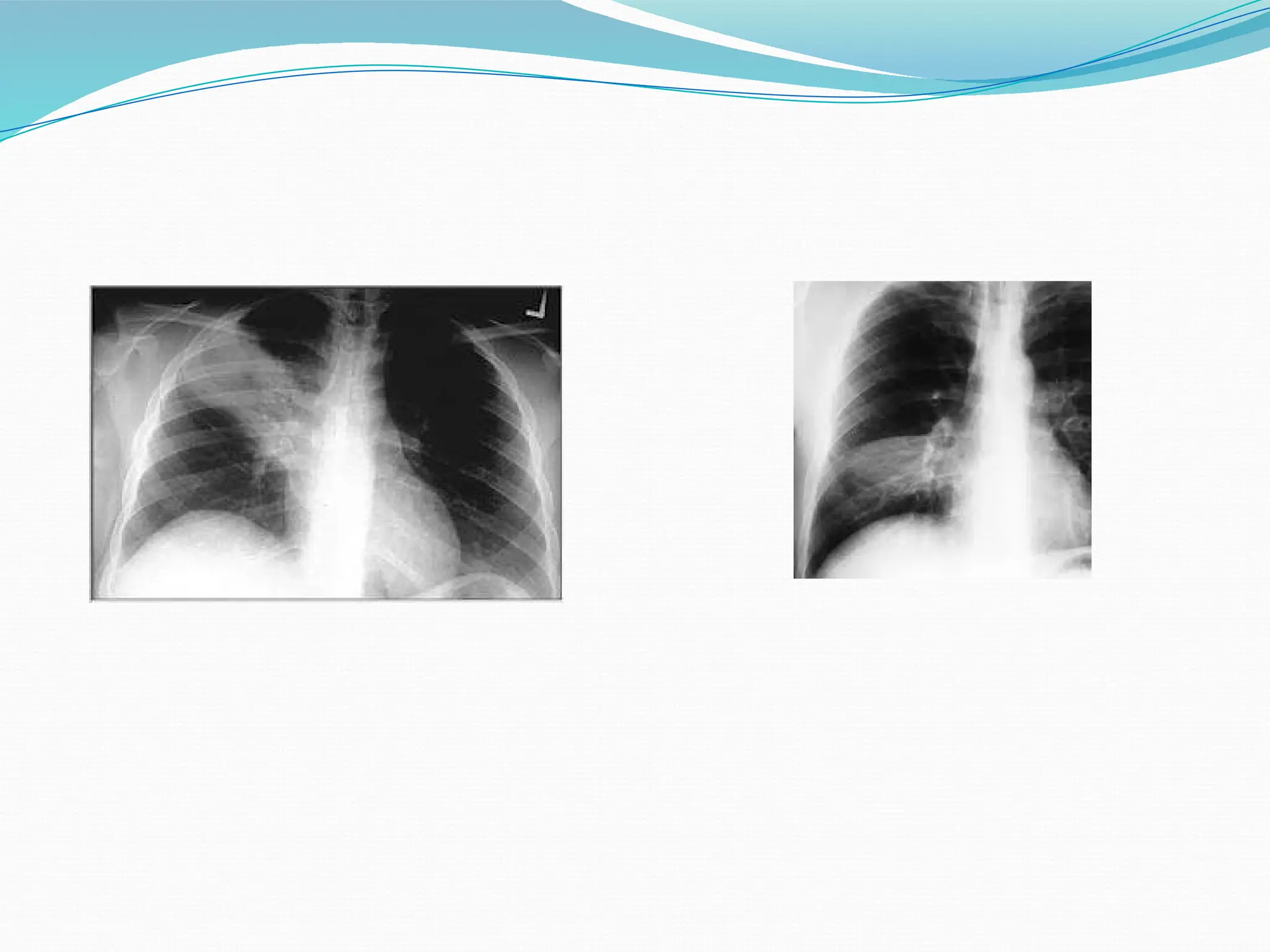 Etiology, pathogenesis, clinical features of pneumonia | PPTX
