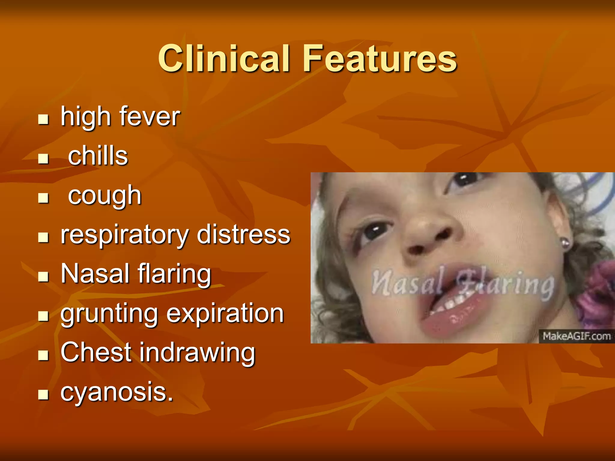 Pneumonia by safiullah | PPTX