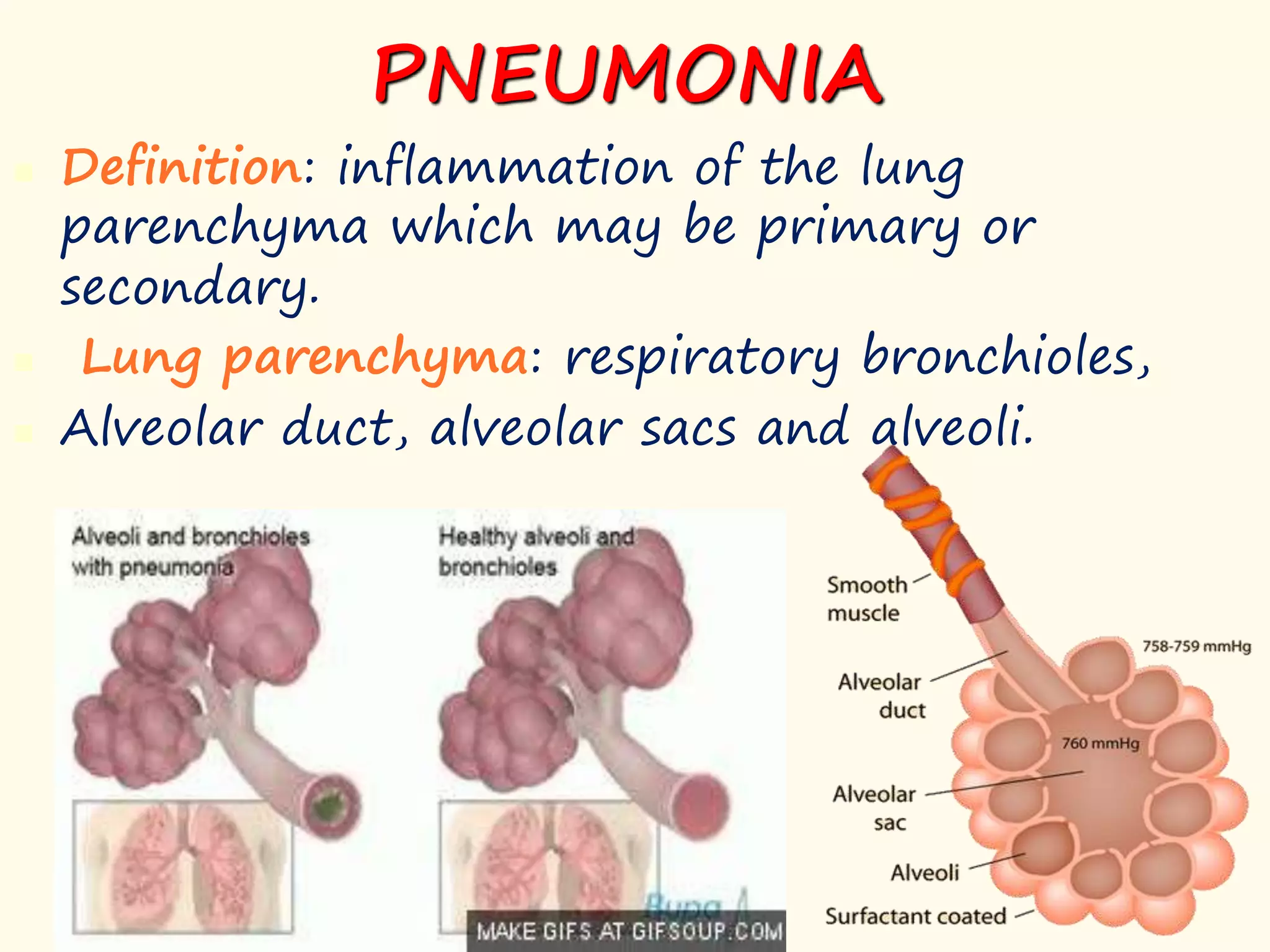 Pneumonia by safiullah | PPTX