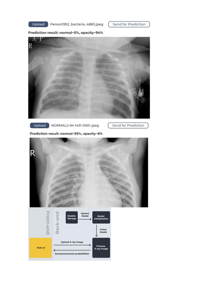 Pneumonia diagnosis tool Case Study | PDF