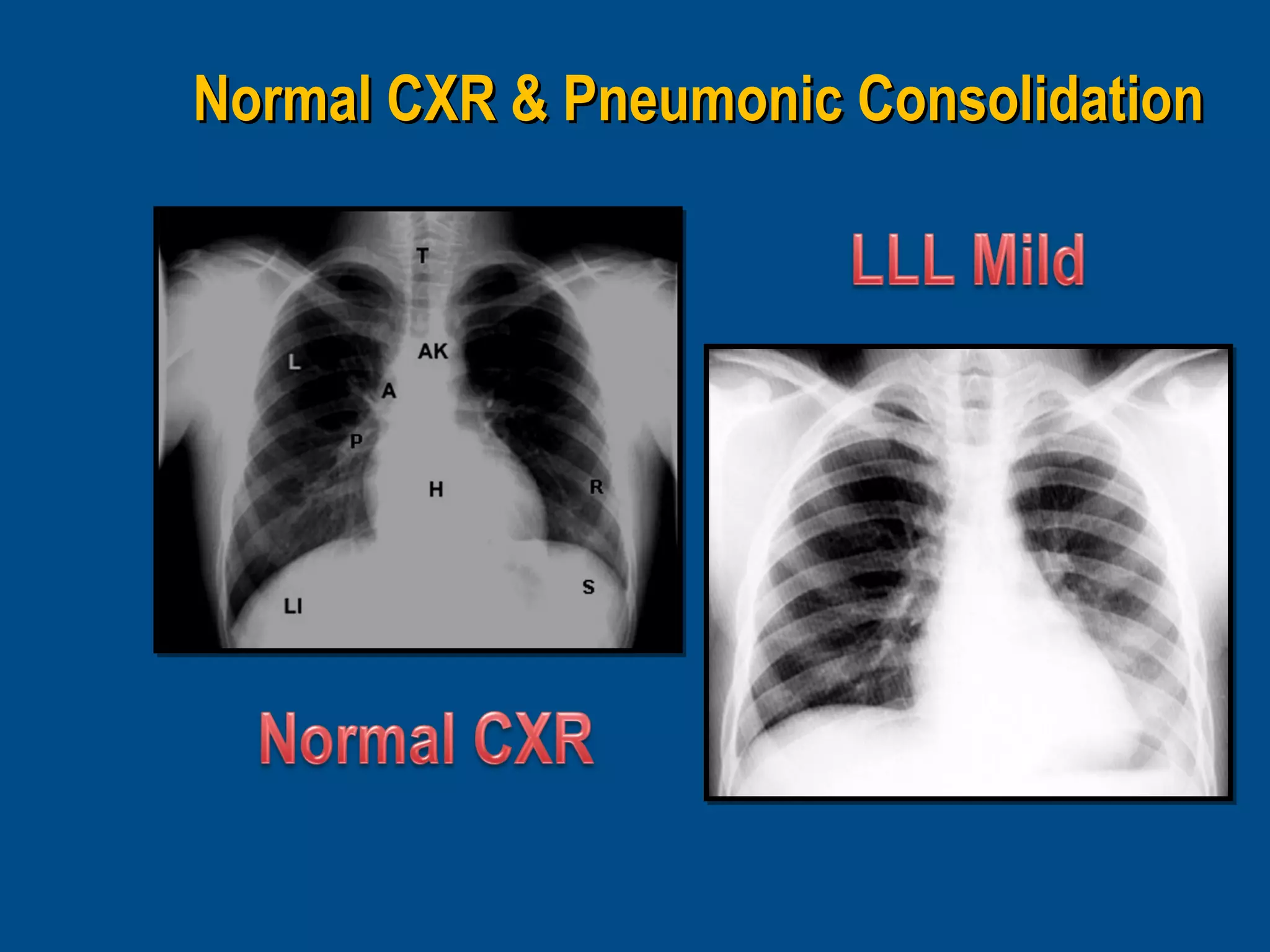 Pneumonia ( Classification,Types and causes,Diagnosis,Treatment ...
