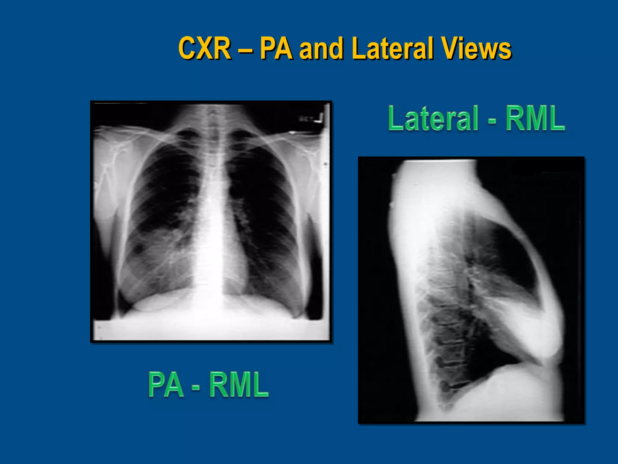 Pneumonia ( Classification,Types and causes,Diagnosis,Treatment ...