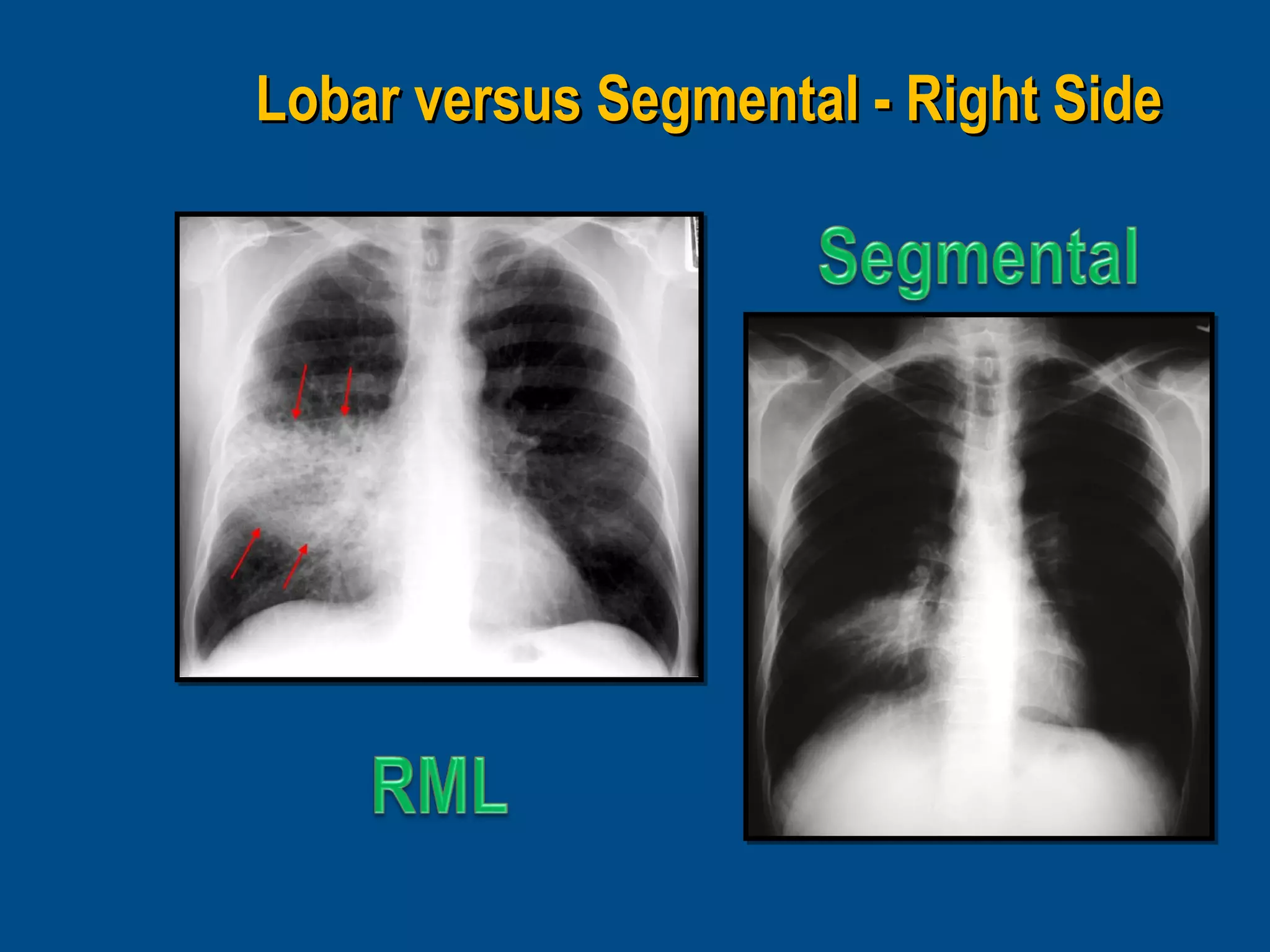 Pneumonia ( Classification,Types and causes,Diagnosis,Treatment ...