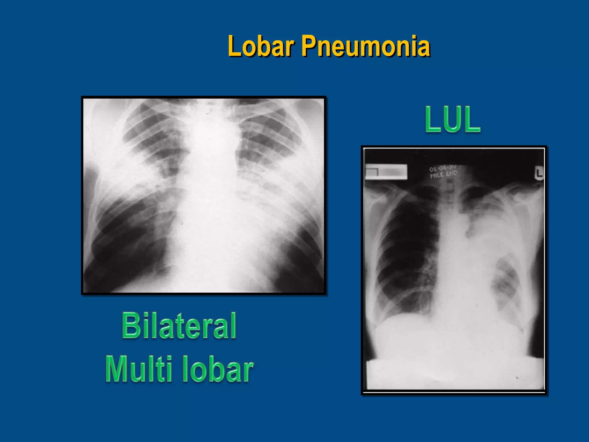 Pneumonia ( Classification,Types and causes,Diagnosis,Treatment ...