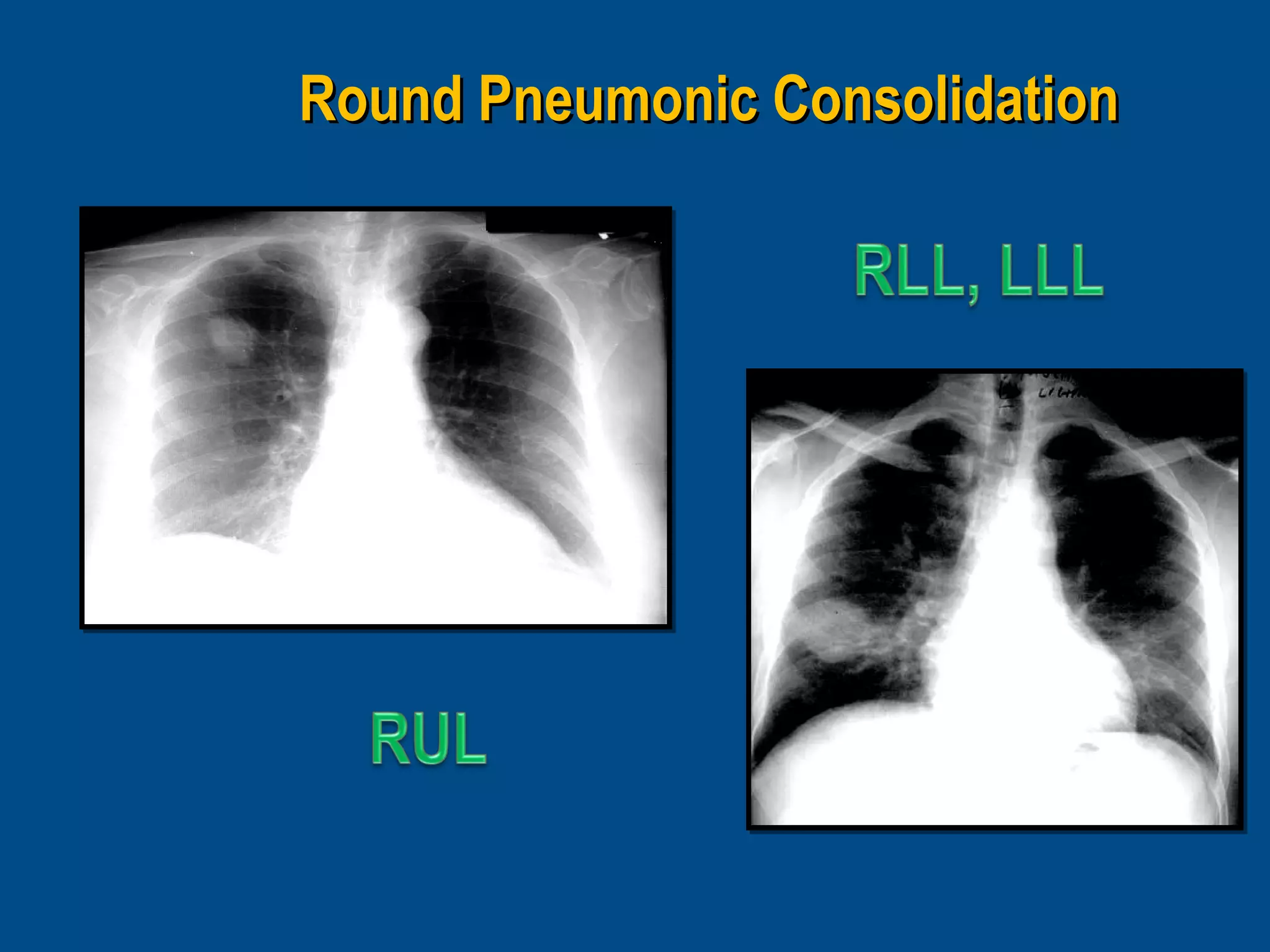 Pneumonia ( Classification,Types and causes,Diagnosis,Treatment ...