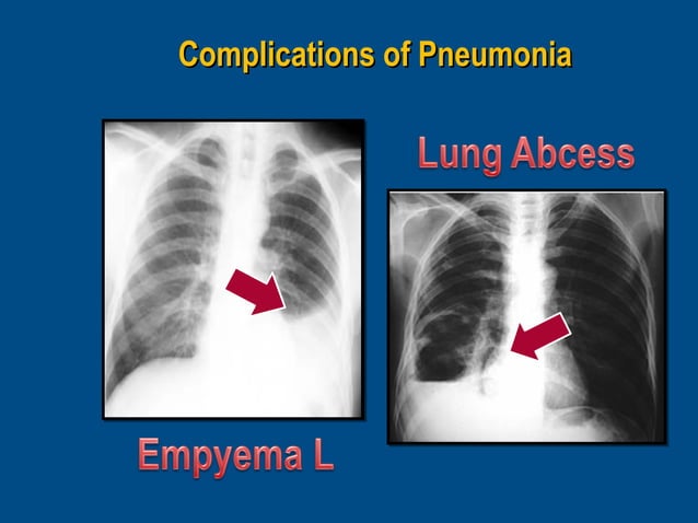 Pneumonia ( Classification,Types and causes,Diagnosis,Treatment ...