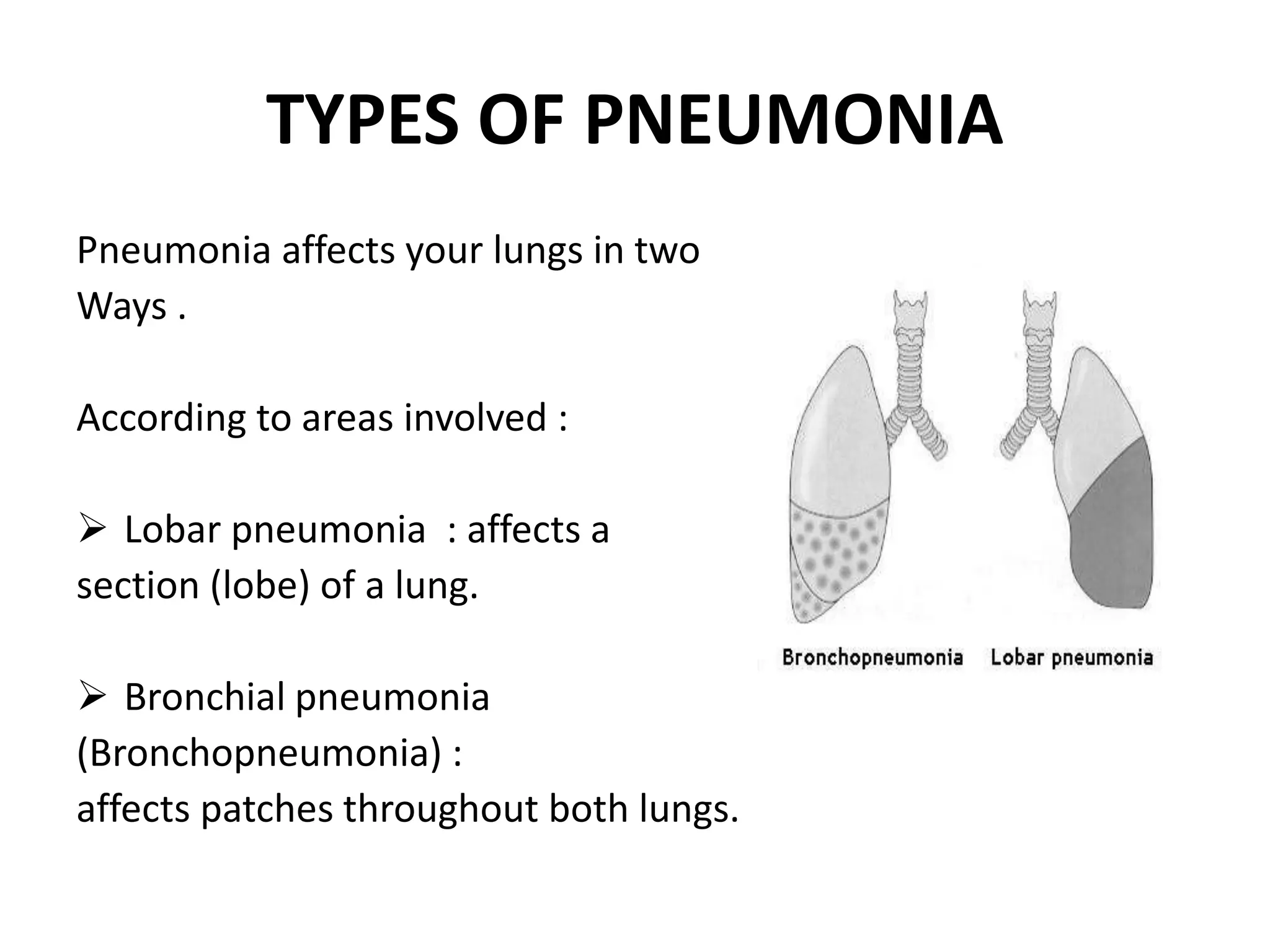 Pneumonia | PPTX