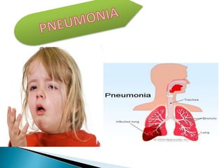 Pneumonia in children | PPTX