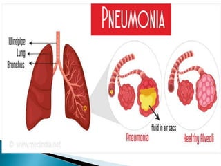 Pneumonia in children | PPTX